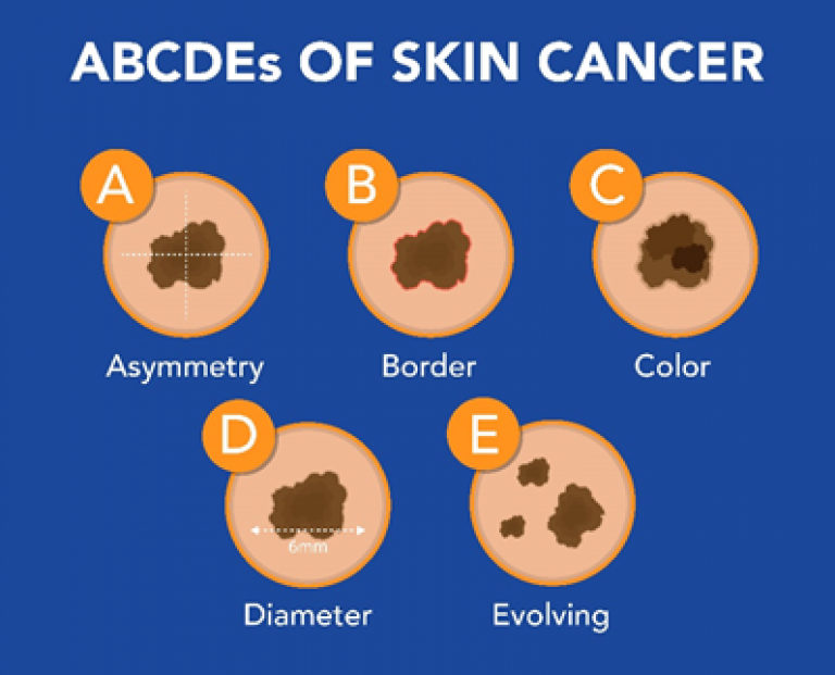 Treat Skin Cancer - Advanced Dermatology & Skin Cancer Center