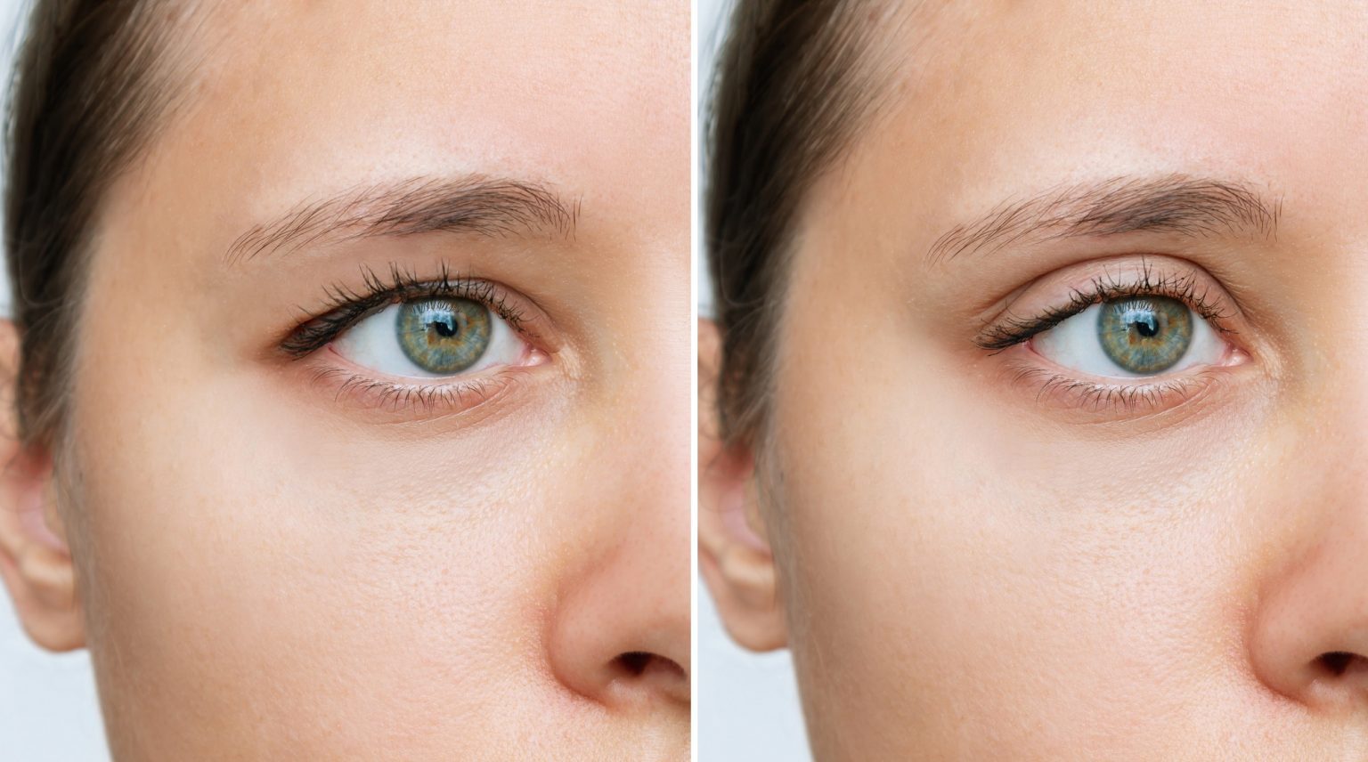 Blepharoplasty | Expert eyelid lift for eye rejuvenation.