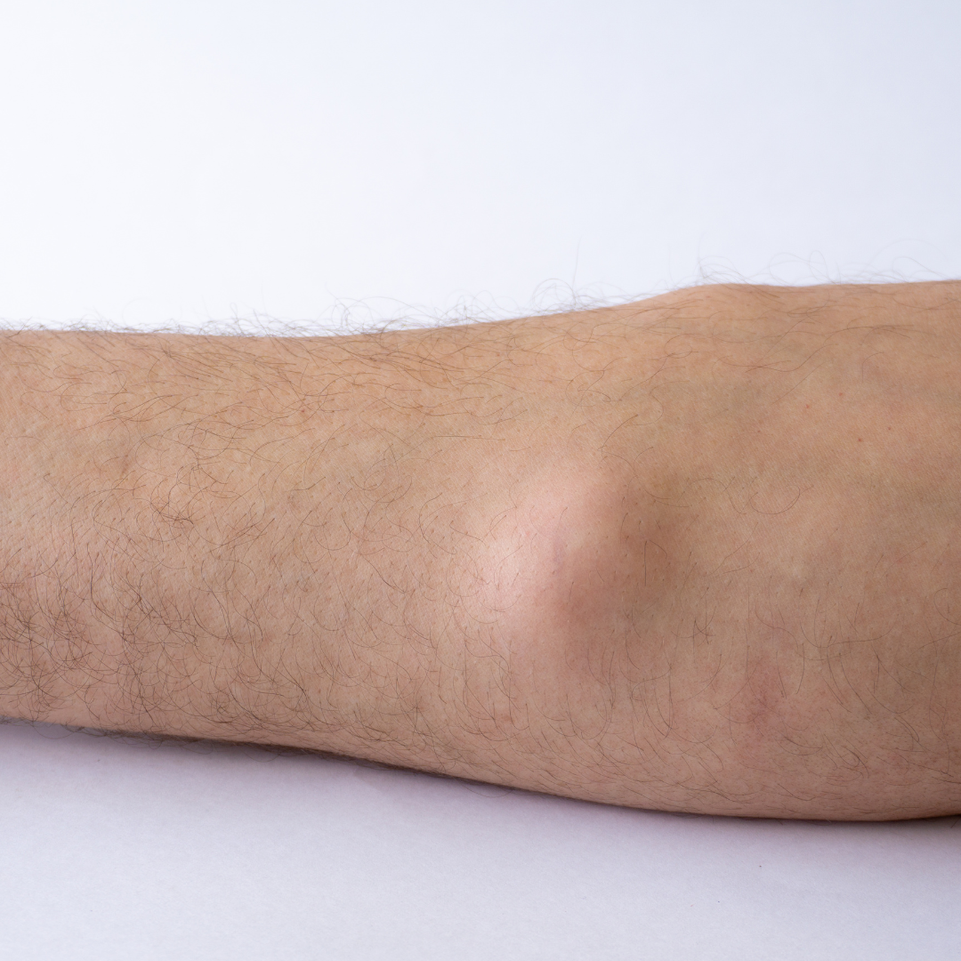 Lipoma | Advanced Dermatology | AdvancedSkinMD.com