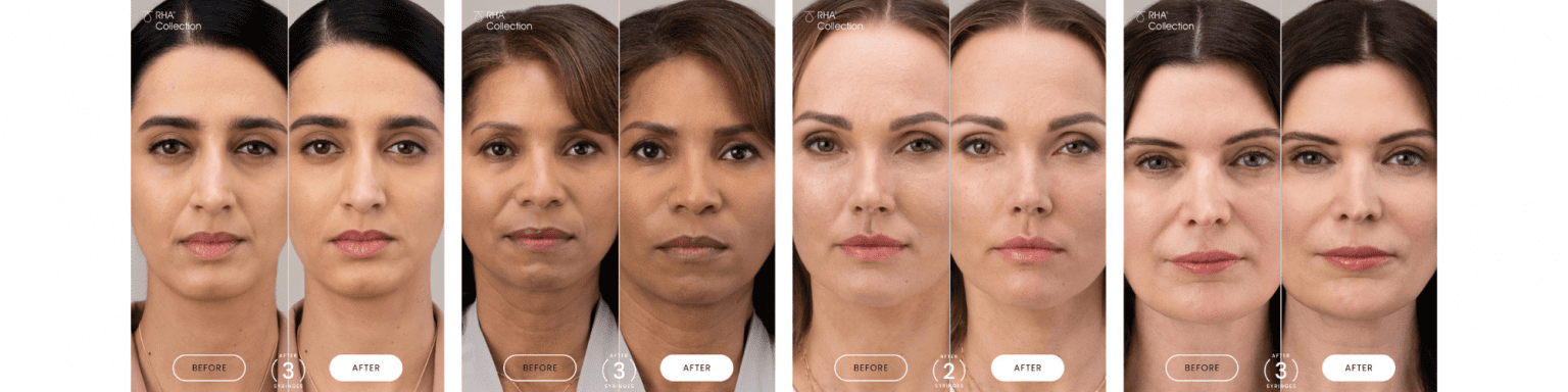 RHA Fillers | Cosmetic Skin Care | Revive Medical Spa, LLC