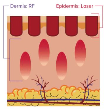 Ultra RF - For Comprehensive Rejuvenation, only at Revive