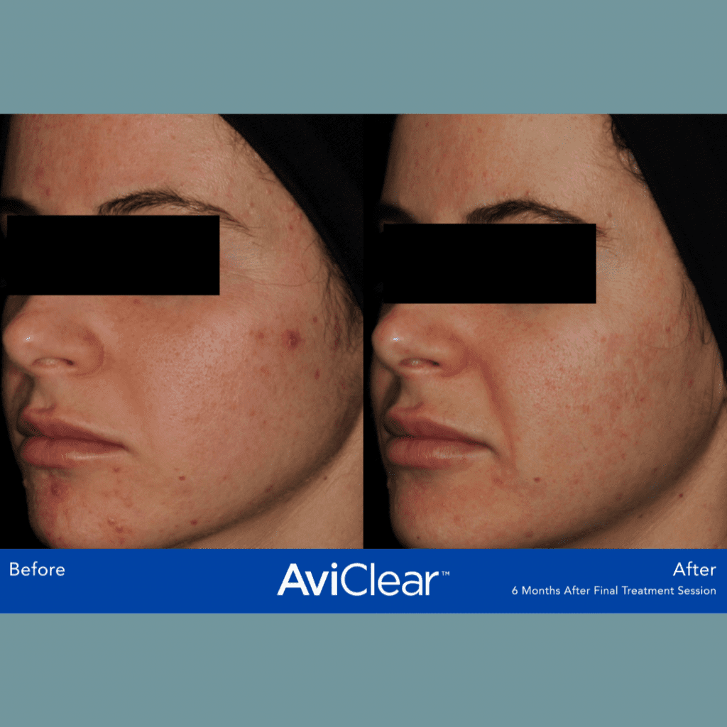 AviClear | Drug-free Acne Treatment at its source!
