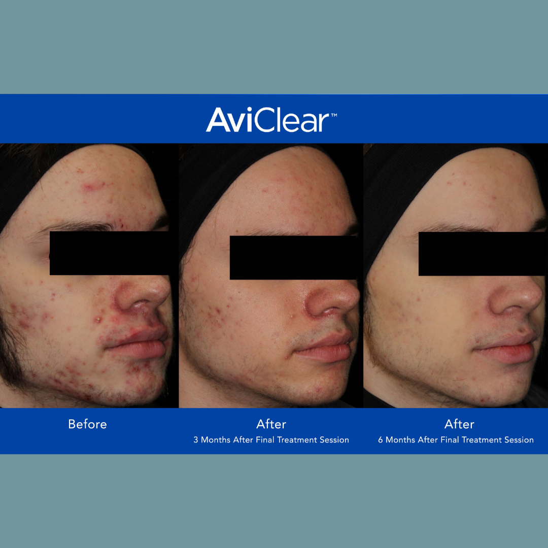 AviClear | Drug-free Acne Treatment at its source!