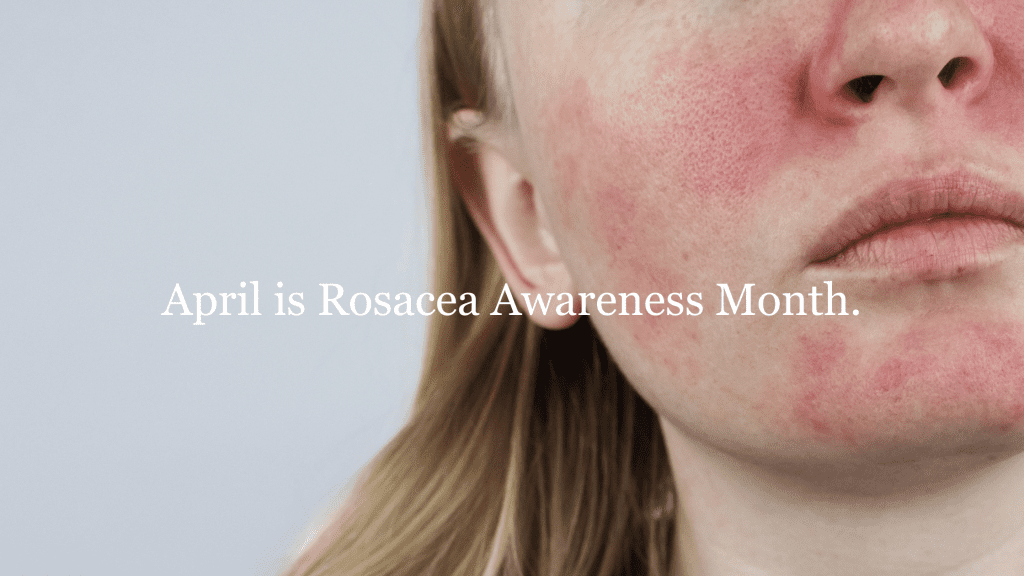Tips for rosacea prone skin - AdvancedSkinMD.com