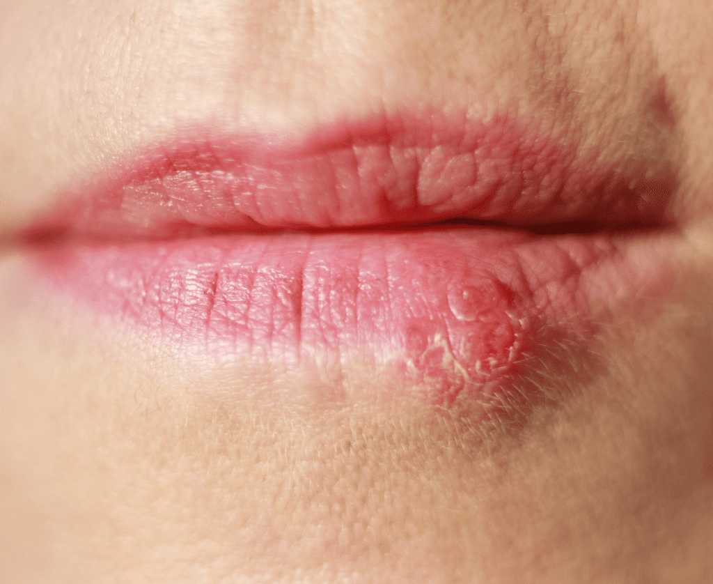 Cold Sores | Treating at home and when to see a Dermatologist