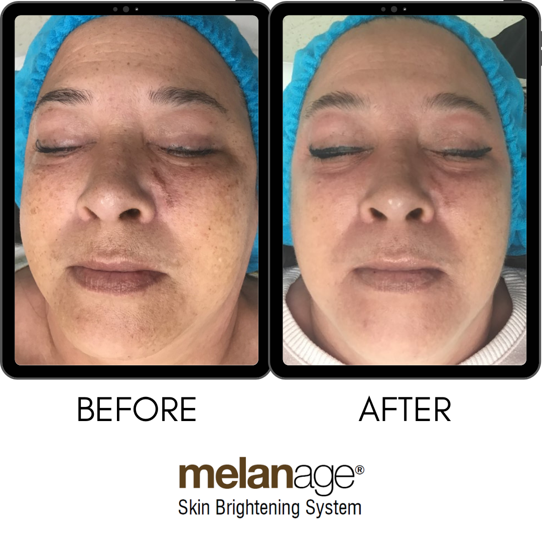 Before and After treatment resultsPRP Facial Before & After Gallery