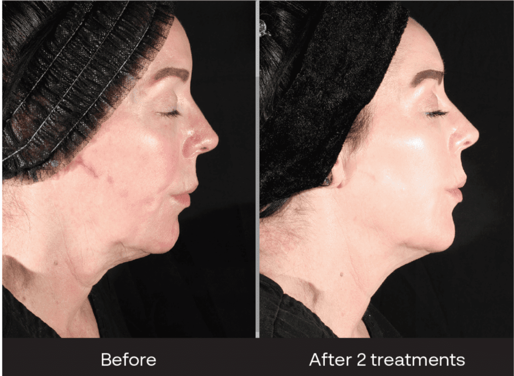 Skin Tightening & Skin Laxity Treatments | Revive Medical Spa