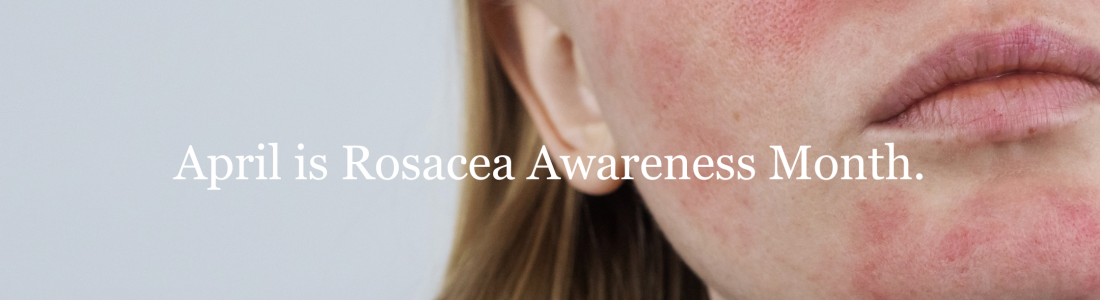Tips for rosacea prone skin - AdvancedSkinMD.com